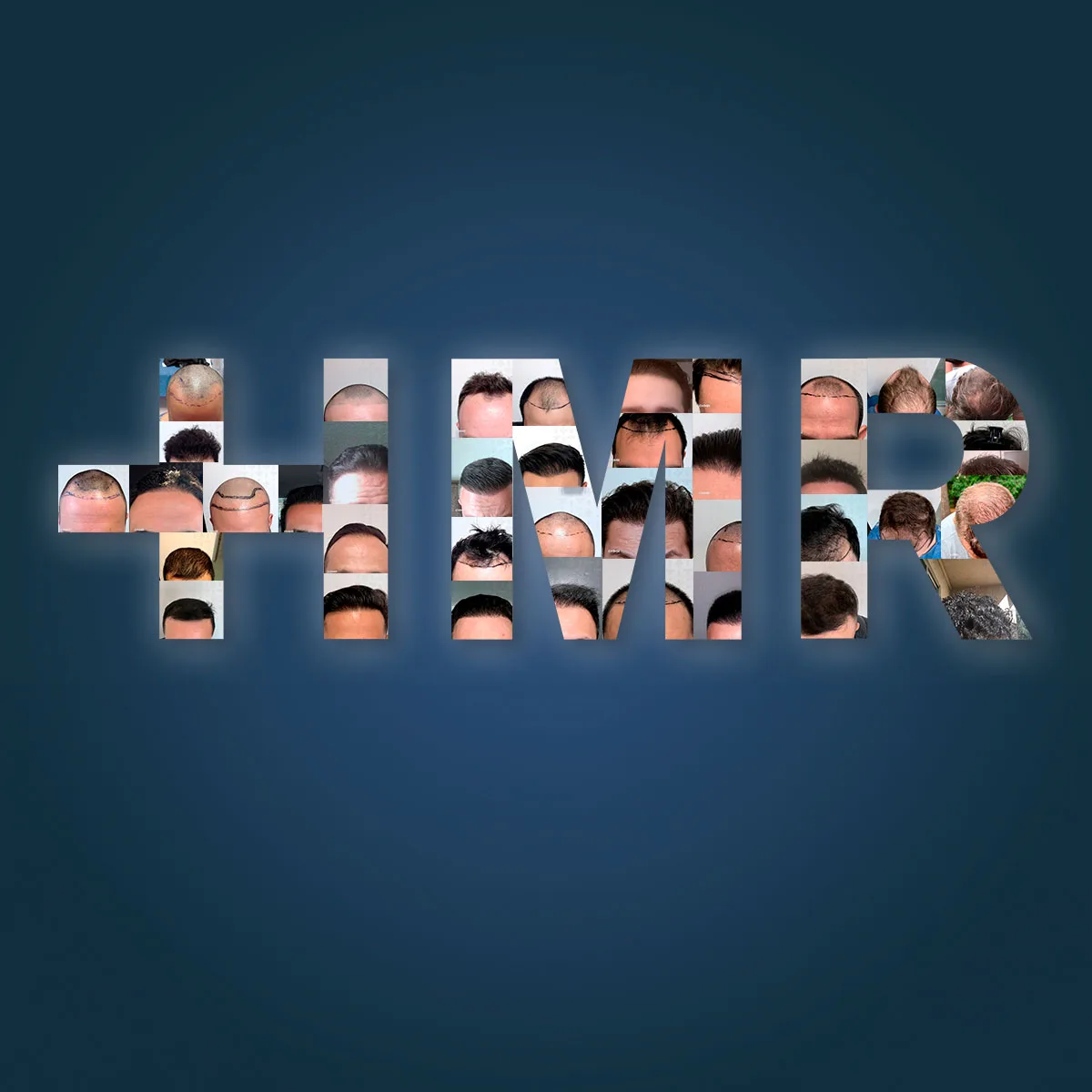 Leading Hair Transplant in Tijuana, México - HMR Tijuana